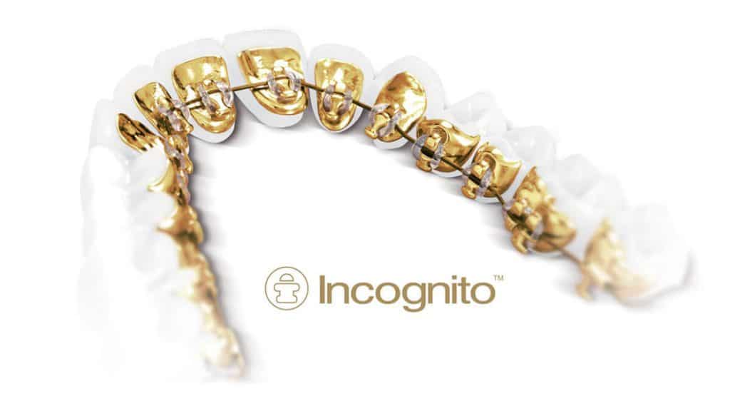 Incognito Braces™ – Advanced Orthodontics