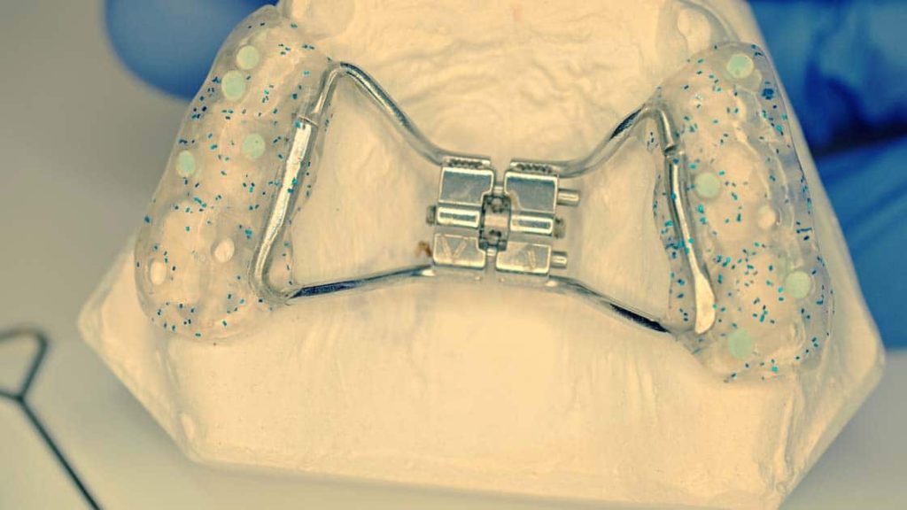 Palatal Expander Device (PED) – Advanced Orthodontics